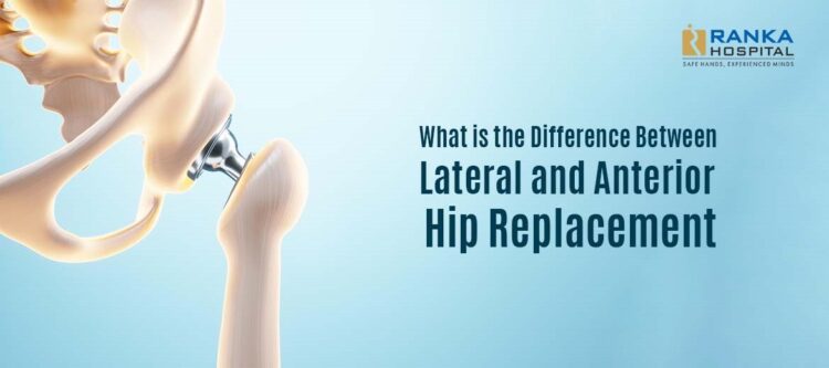 What is the Difference Between Lateral and Anterior Hip Replacement ...